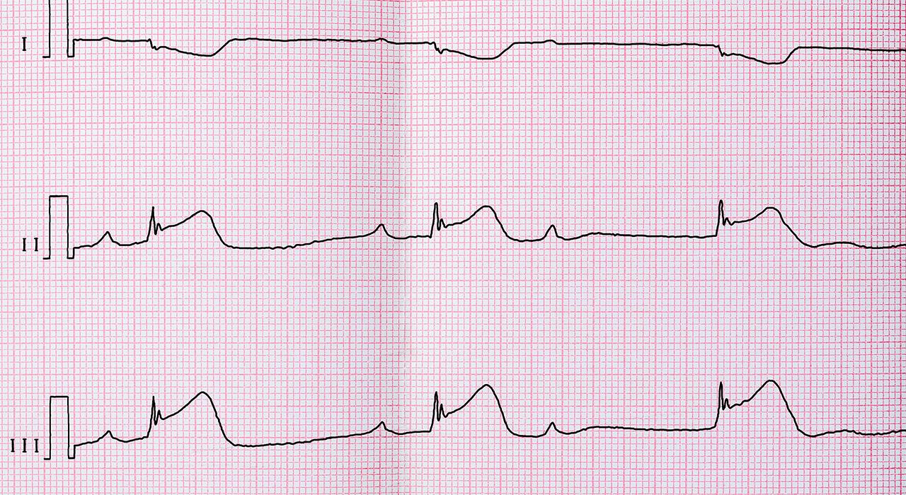 Diplomado en Manejo del Paciente Crítico con Síndrome Coronario Agudo en UCI - TECH Argentina